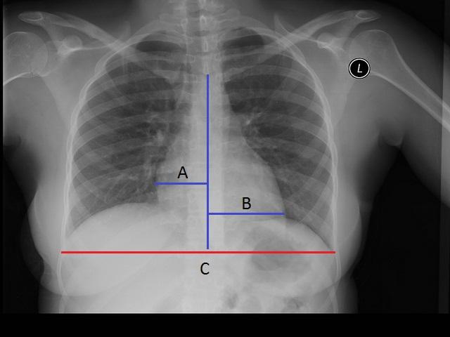 Cardiomegalia: síntomas, clasificación, causas y tratamiento ...