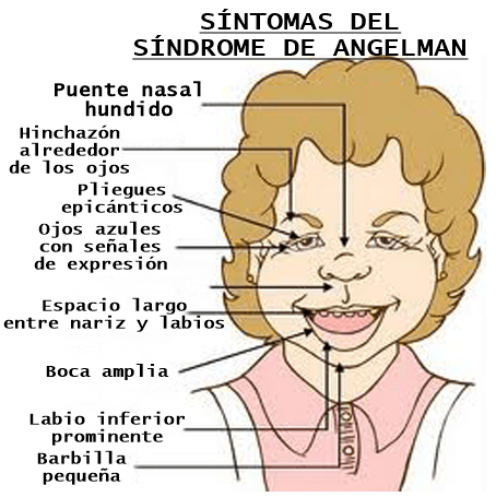 Síndrome de Angelman: sintomas, causas, tratamentos - Maestrovirtuale.com